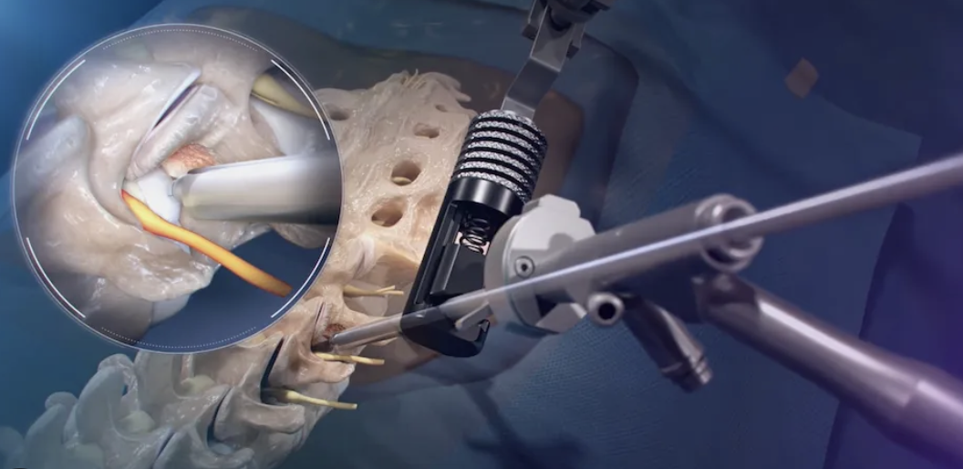 Hoag Orthopedic Institute Surgeon First Performs Ultra Minimally ...